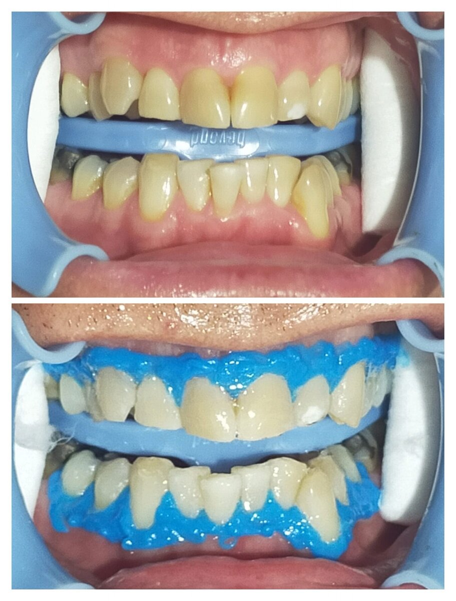 In-House Whitening | Vivian Dental