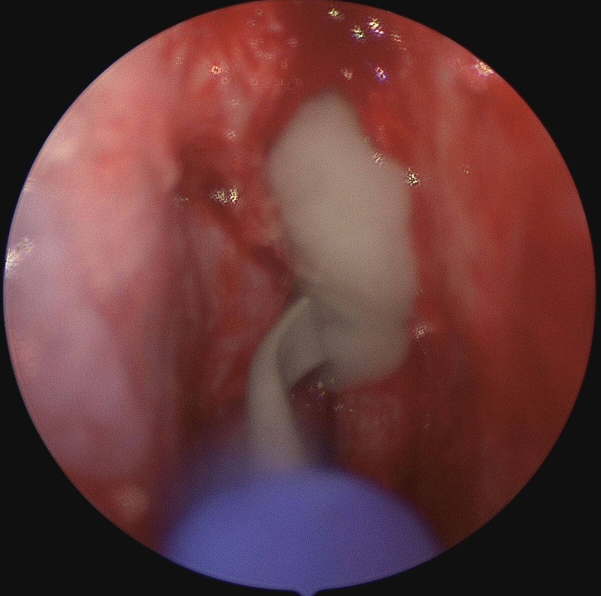 Endoscopic DCR Surgery Palmerston North | ENT Central