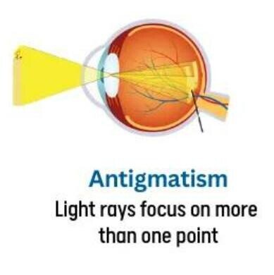 📣 What is Astigmatism? 🤓 | Ashburton Eyecare