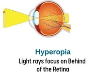 Understanding Hyperopia (Farsightedness) | Ashburton Eyecare