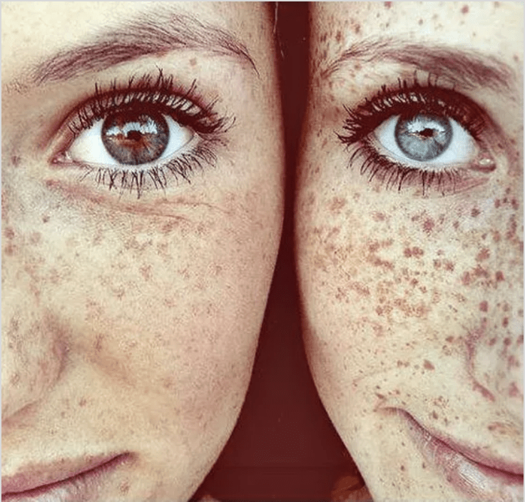 What you need to know about pigmentation and how to treat it. | Harleh ...