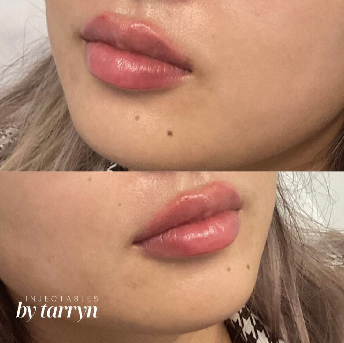 Services | Injectables by Tarryn