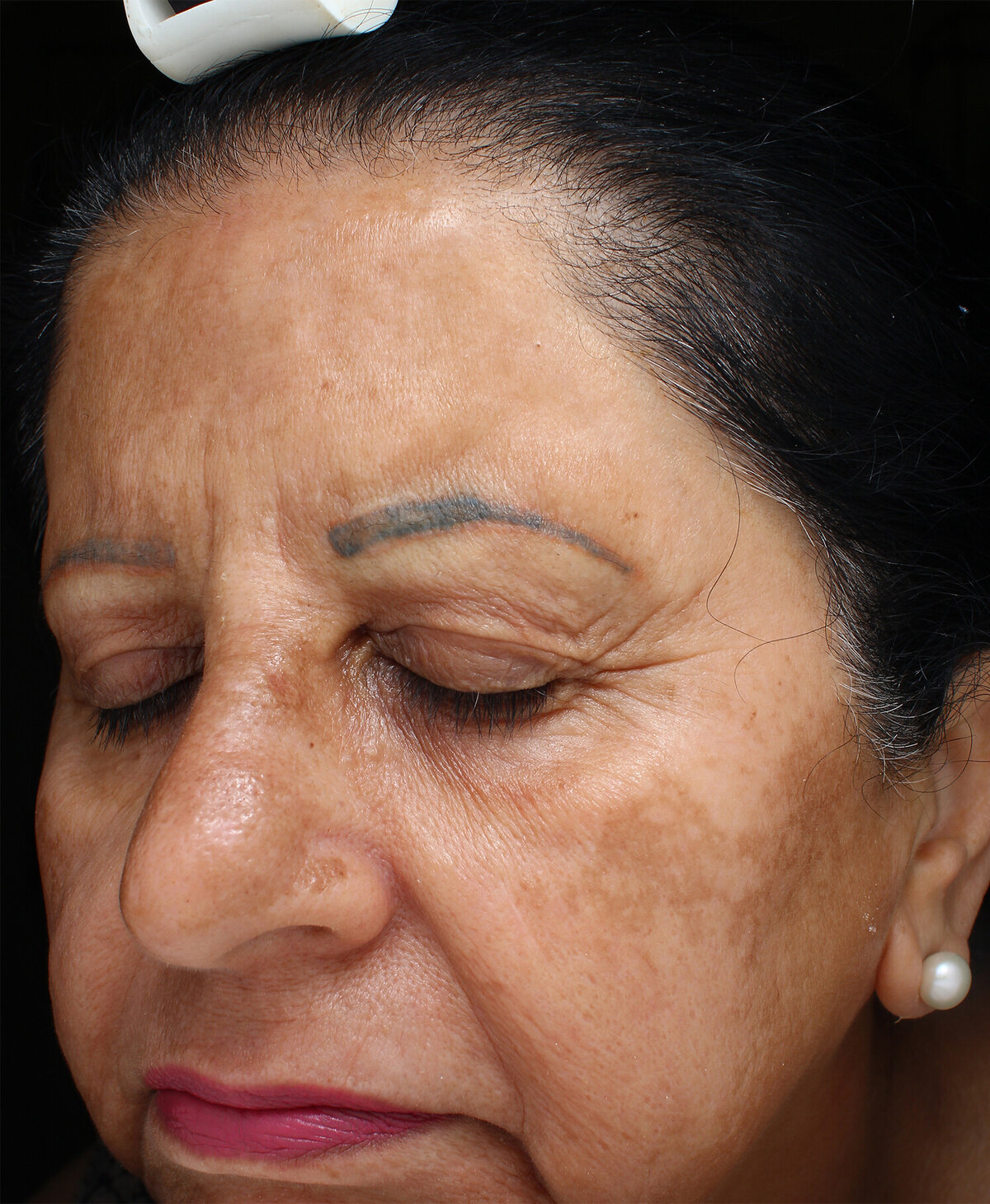 Illuminate Me | Depigmentation Treatment | Cosmelan for ...