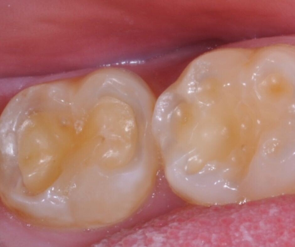 Tooth Wear | Tooth Wear NZ