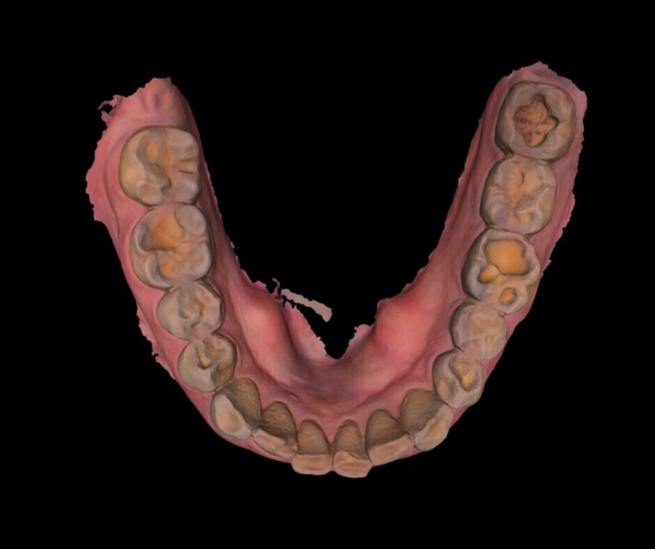 Tooth Wear | Tooth Wear NZ