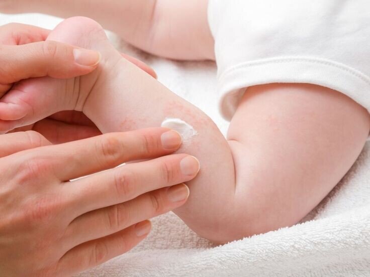 Eczema: Just because it’s ‘common’ doesn’t mean it’s normal | Mother ...