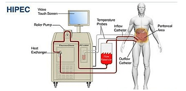 Braemar Trust donates HIPEC machine to improve cancer treatment in our ...