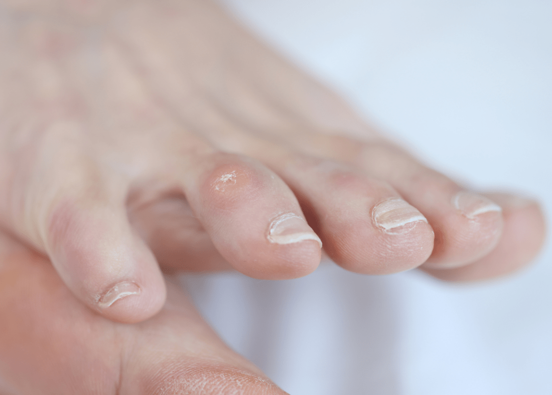 Corns and Callus Treatment in Hamilton | Feet Forward Podiatry