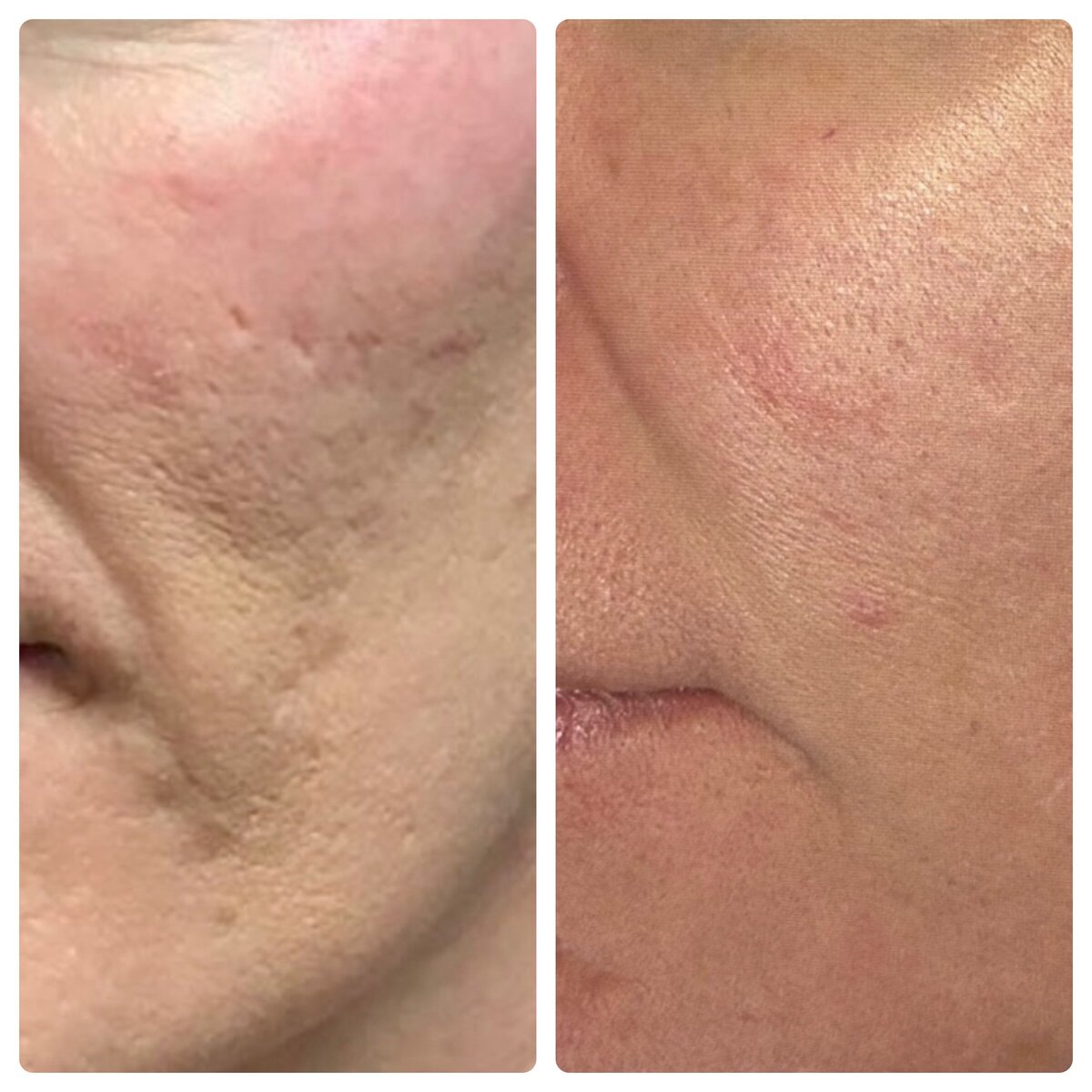 Micro-needling Treatments in Cambridge, NZ
