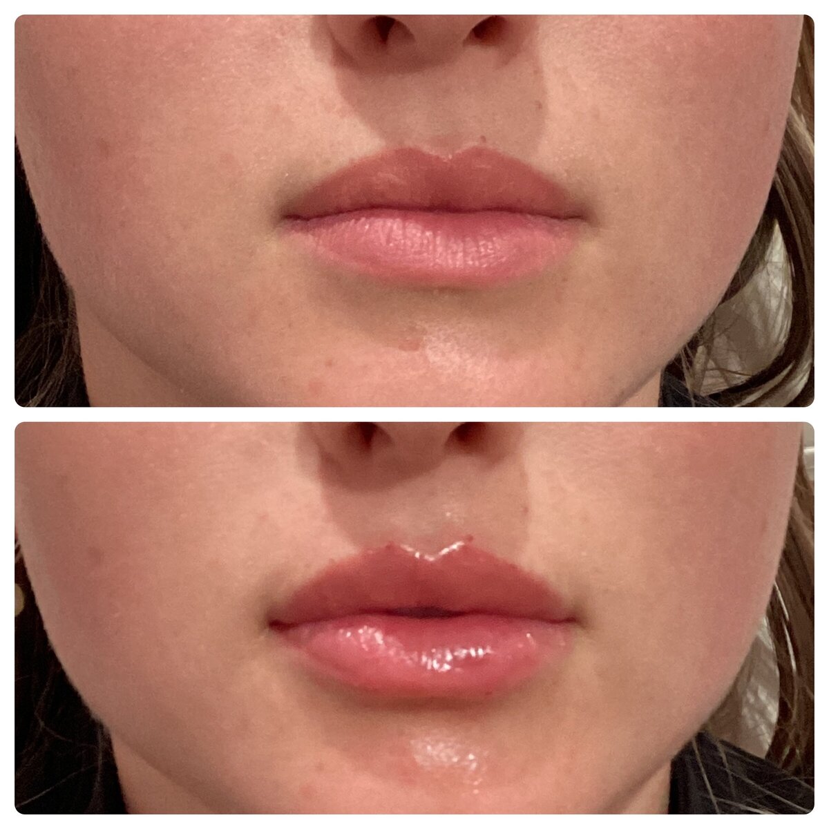 Dermal Fillers in Cambridge, NZ – Beautiful Is You