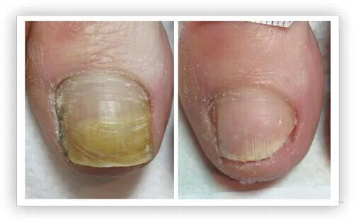 Effective Topical Treatments | Foot Foundation