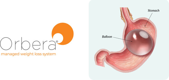 Orbera Balloon | Franklin Hospital